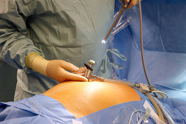 Laparoscopic Surgery Stock Photos, Pictures & Royalty-Free Images - iStock Laparoscopic Surgery Stock Photos, Pictures & Royalty-Free Images - iStock