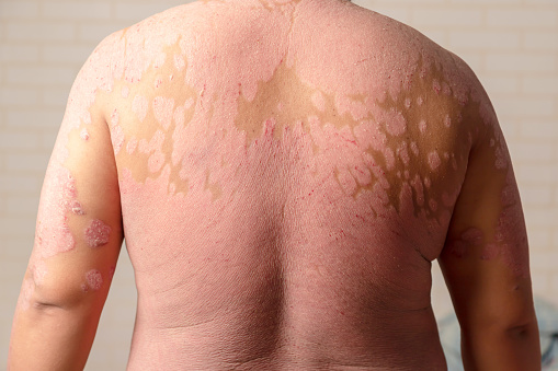 Photo libre de droit de Maladies Causées Par Des Anomalies De La Lymphe ... Photo libre de droit de Maladies Causées Par Des Anomalies De La Lymphe ...