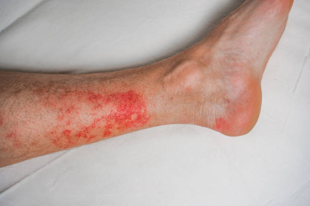 Erupción En Las Piernas - Banco de fotos e imágenes de stock - iStock Erupción En Las Piernas - Banco de fotos e imágenes de stock - iStock