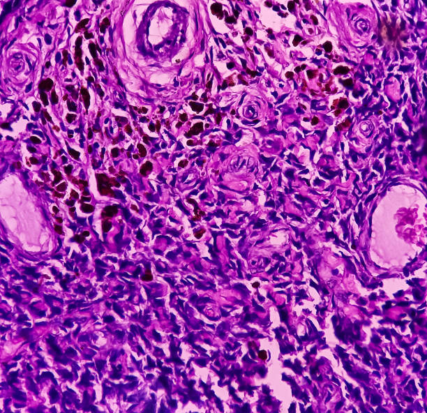 Synovial Sarcoma Stock Photos, Pictures & Royalty-Free Images - iStock Synovial Sarcoma Stock Photos, Pictures & Royalty-Free Images - iStock