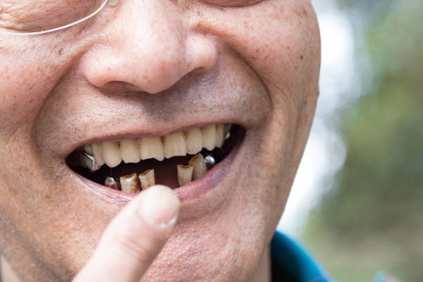 Old Man Missing Teeth Stock Photos, Pictures & Royalty-Free Images - iStock Old Man Missing Teeth Stock Photos, Pictures & Royalty-Free Images - iStock