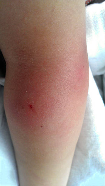 Infected Forearm From Mosquito Bite Stock Photos, Pictures & Royalty ... Infected Forearm From Mosquito Bite Stock Photos, Pictures & Royalty ...
