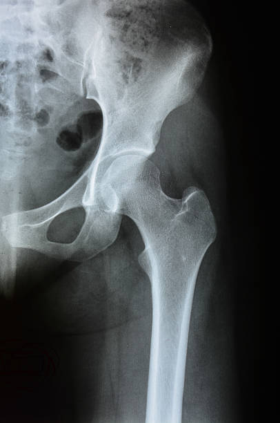 Hip Arthritis X Ray Stock Photos, Pictures & Royalty-Free Images - iStock Hip Arthritis X Ray Stock Photos, Pictures & Royalty-Free Images - iStock