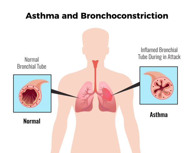 Asthma Triggers Illustrations, Royalty-Free Vector Graphics & Clip Art ... Asthma Triggers Illustrations, Royalty-Free Vector Graphics & Clip Art ...