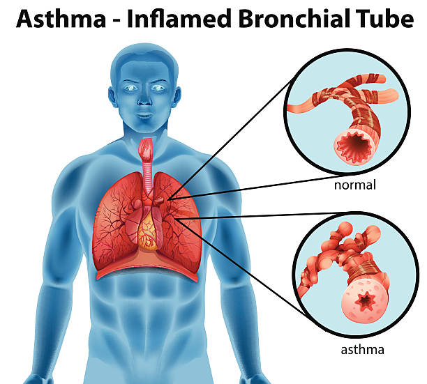 Asthma Triggers Illustrations, Royalty-Free Vector Graphics & Clip Art ... Asthma Triggers Illustrations, Royalty-Free Vector Graphics & Clip Art ...