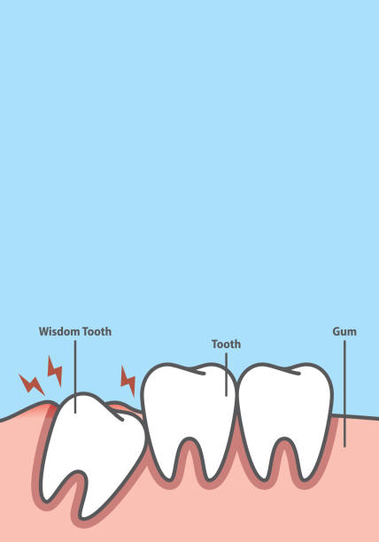 Impacted Tooth Stock Photos, Pictures & Royalty-Free Images - iStock Impacted Tooth Stock Photos, Pictures & Royalty-Free Images - iStock