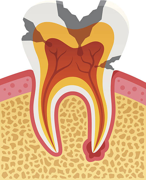 Best Tooth Decay Illustrations, Royalty-Free Vector Graphics & Clip Art ... Best Tooth Decay Illustrations, Royalty-Free Vector Graphics & Clip Art ...