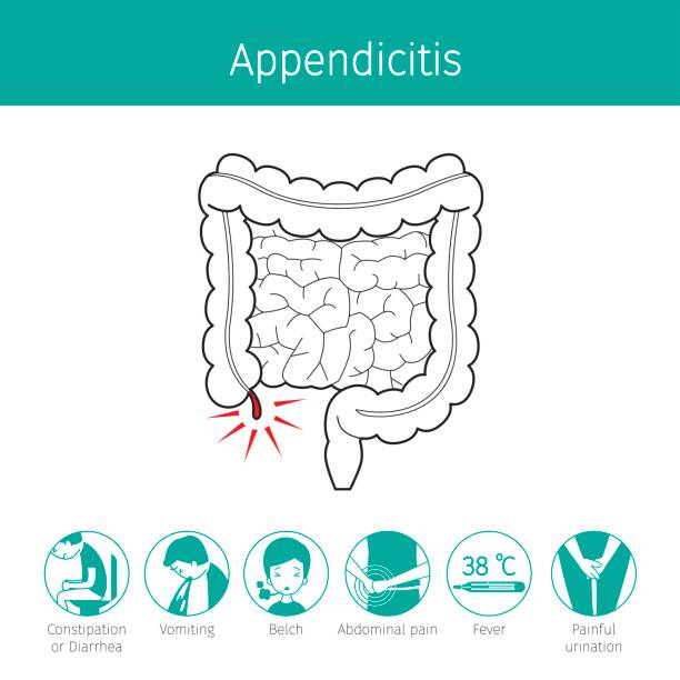 Appendicitis Illustrations, Royalty-Free Vector Graphics & Clip Art ... Appendicitis Illustrations, Royalty-Free Vector Graphics & Clip Art ...
