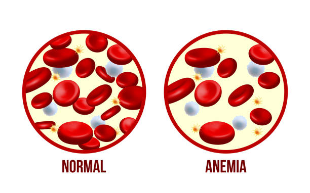 Anemia Diagram Illustrations, Royalty-Free Vector Graphics & Clip Art ... Anemia Diagram Illustrations, Royalty-Free Vector Graphics & Clip Art ...