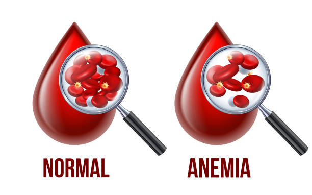 Anemia Symptoms Illustrations, Royalty-Free Vector Graphics & Clip Art ... Anemia Symptoms Illustrations, Royalty-Free Vector Graphics & Clip Art ...