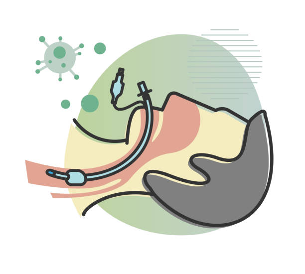Intubation Illustrations, Royalty-Free Vector Graphics & Clip Art - iStock Intubation Illustrations, Royalty-Free Vector Graphics & Clip Art - iStock