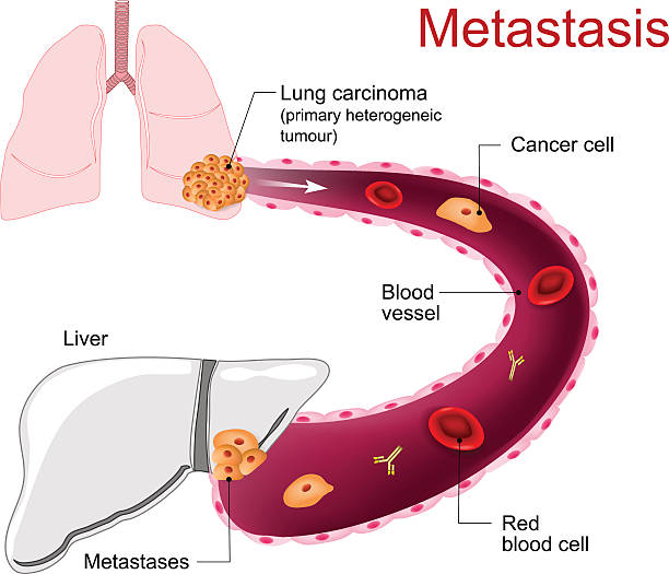 Royalty Free Metastasis Clip Art, Vector Images & Illustrations - iStock Royalty Free Metastasis Clip Art, Vector Images & Illustrations - iStock