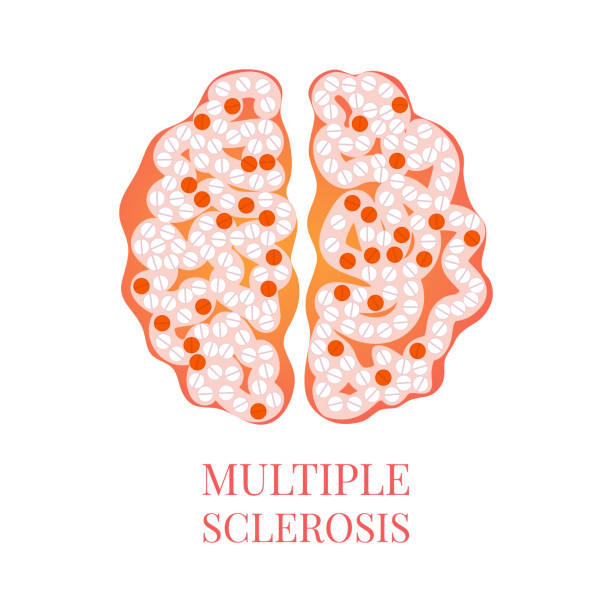 Multiple Sclerosis Illustrations, Royalty-Free Vector Graphics & Clip ... Multiple Sclerosis Illustrations, Royalty-Free Vector Graphics & Clip ...