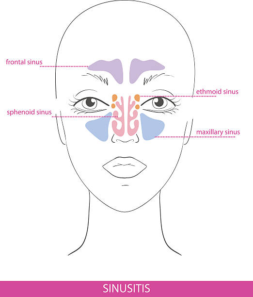Royalty Free Sinusitis Clip Art, Vector Images & Illustrations - iStock Royalty Free Sinusitis Clip Art, Vector Images & Illustrations - iStock