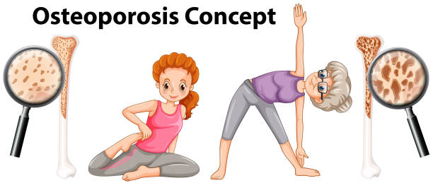 Osteoporosis Bone Illustrations, Royalty-Free Vector Graphics & Clip ... Osteoporosis Bone Illustrations, Royalty-Free Vector Graphics & Clip ...