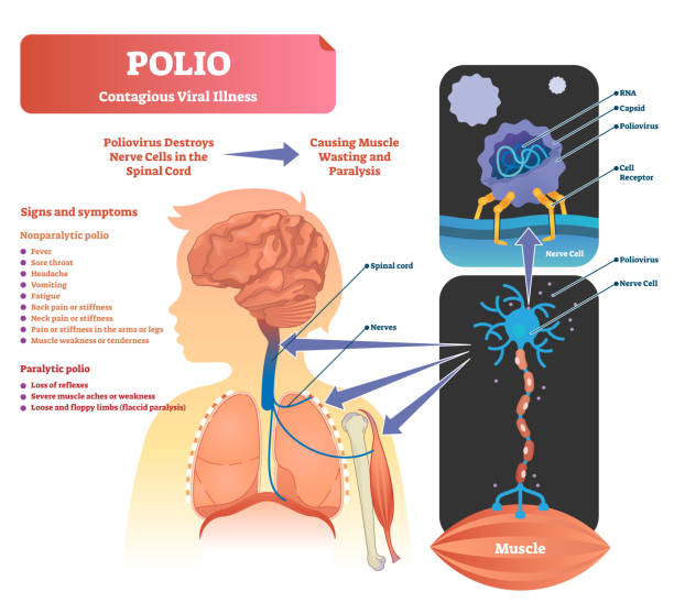 Polio Virus Illustrations, Royalty-Free Vector Graphics & Clip Art - iStock Polio Virus Illustrations, Royalty-Free Vector Graphics & Clip Art - iStock