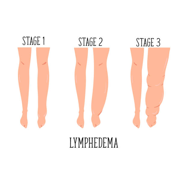 Lymphedema Stock Photos, Pictures & Royalty-Free Images - iStock Lymphedema Stock Photos, Pictures & Royalty-Free Images - iStock