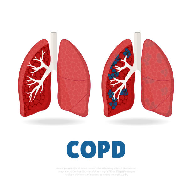 Copd Patient Illustrations Illustrations, Royalty-Free Vector Graphics ... Copd Patient Illustrations Illustrations, Royalty-Free Vector Graphics ...