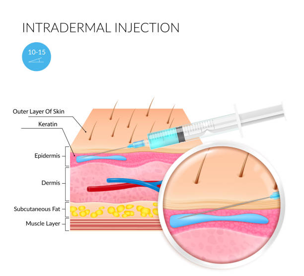 Intradermal And Subcutaneous Injection Vector Illustr - vrogue.co Intradermal And Subcutaneous Injection Vector Illustr - vrogue.co