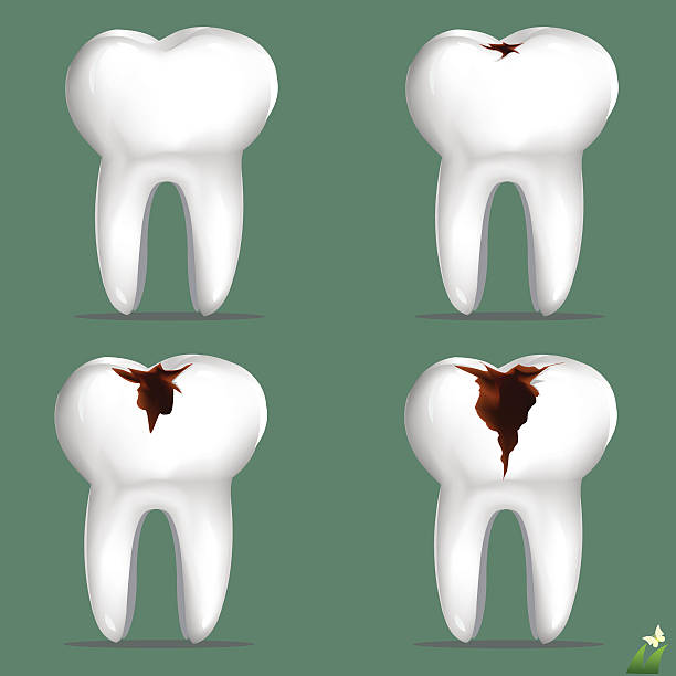 Best Tooth Decay Illustrations, Royalty-Free Vector Graphics & Clip Art ... Best Tooth Decay Illustrations, Royalty-Free Vector Graphics & Clip Art ...