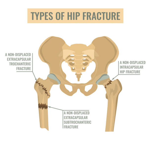 Comminuted Fracture Illustrations, Royalty-Free Vector Graphics & Clip ... Comminuted Fracture Illustrations, Royalty-Free Vector Graphics & Clip ...